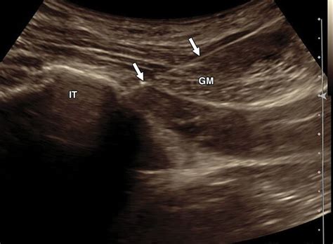 Hamstring Origin Percutaneous Needle Tenotomy Wikism Sports Medicine Wiki
