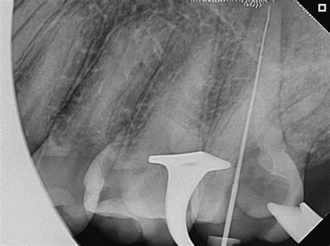 Ledge Bypass Myzerodonto