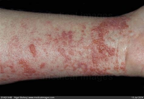 Stock Image The Inner Wrist And Arm Of A Sixty Year Old Woman With Phytodermatitis Associated