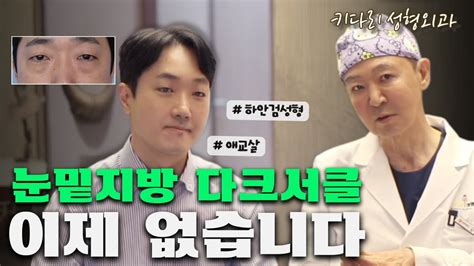 다크서클 애교살 ‍🔥눈밑지방 다크서클 ‍🔥이제 없습니다 Youtube