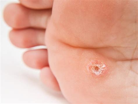 Основные методы лечения мозолей и натоптышей на ногах