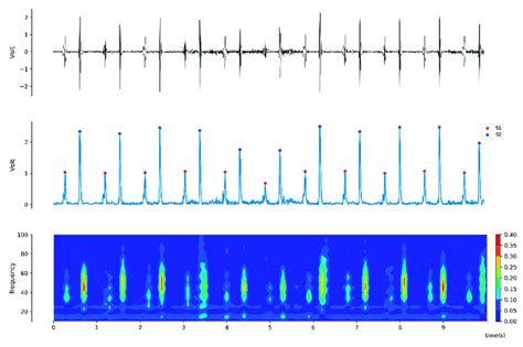 Representative Plot Of Intraoperative Phonocardiogram Upper And Download Scientific Diagram