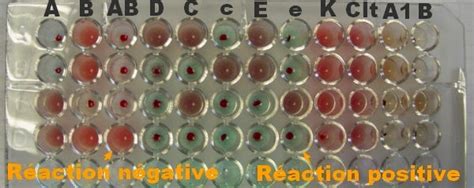 Pdf Télécharger Test Dagglutination Groupe Sanguin Gratuit Pdf