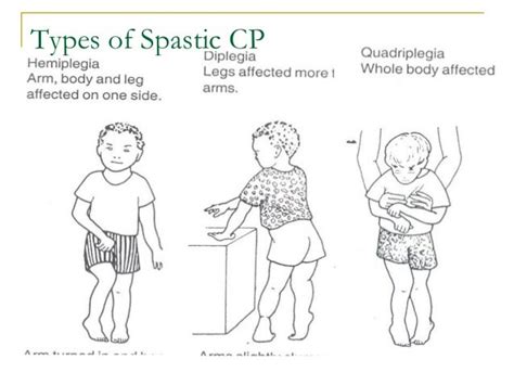 Spasticity Management In Cerebral Palsy