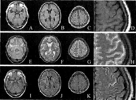 Figure 1 From Osmotic Demyelination Syndrome Reversible Mri Findings