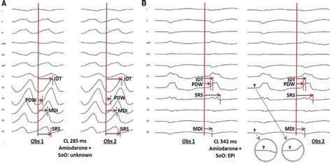 Reported Interval And Morphological Ecg Criteria For Identifying A Left Download Scientific