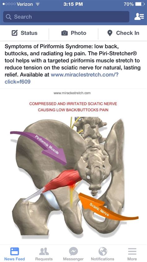 Pin By Jamie Watt On Medical Information Piriformis Syndrome Sciatic