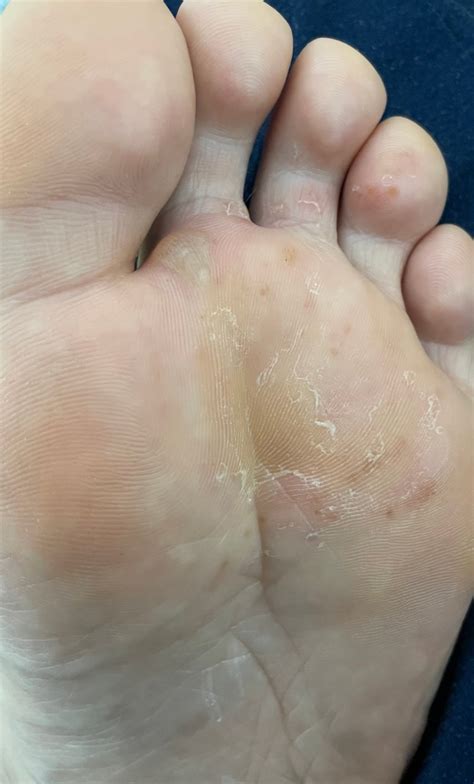 발바닥 무좀 한포진 지식in