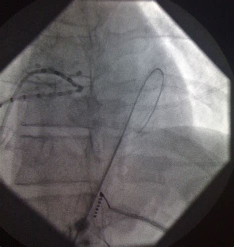 Insertion Of Guidewire In The Pericardial Space Following Subxiphoid Download Scientific
