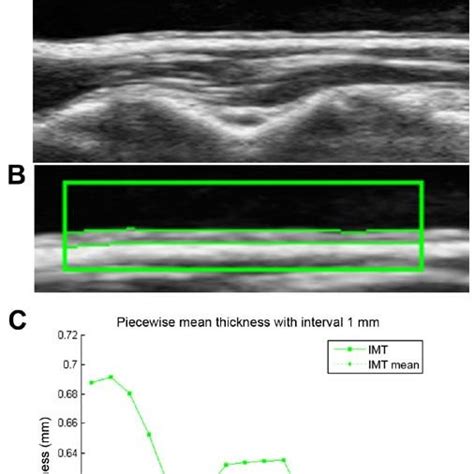 Carotid Imt And Intima Media Roughness Measurements A Ultrasound Download Scientific Diagram