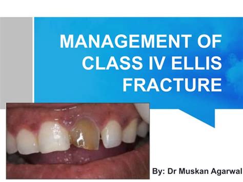 Management Of Ellis Class Iv Fracture Pptx