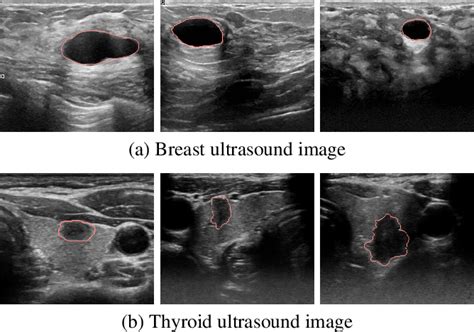 Figure 1 From Cmu Net A Strong Convmixer Based Medical Ultrasound