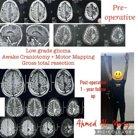 Gliomas In Eloquent Areas Adjuvant Tools And Localization Ahmed Ali Morsy Posted On The Topic
