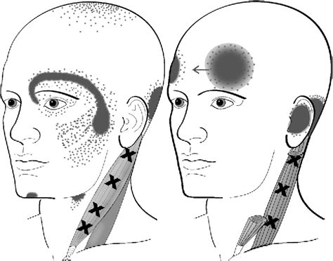 Sternocleidomastoid Trigger Points