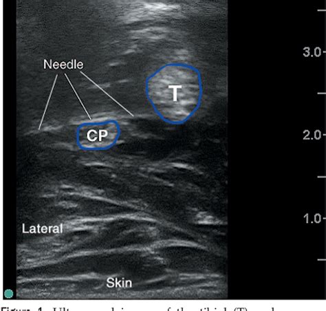Figure 1 From Ultrasound Guided Sciatic Nerve Block In The Popliteal Fossa Using A Lateral