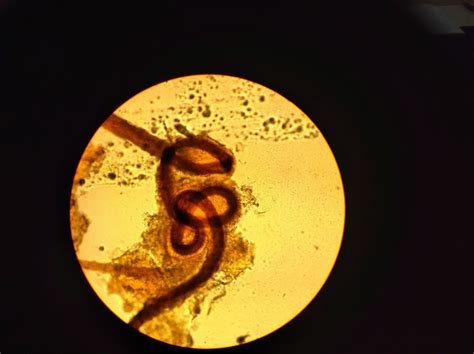 Elham Eskandari On Linkedin Endothrix Tinea Capitis