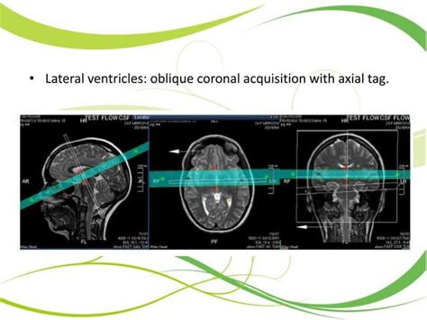 Csf Flow Study Pptx