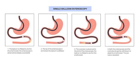 Premium Vector Single Balloon Enteroscopy Procedure Visualization Of