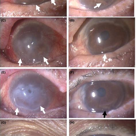 Biomicroscopic Images Diffuse Scleritis With Massive Peripheral Download Scientific Diagram