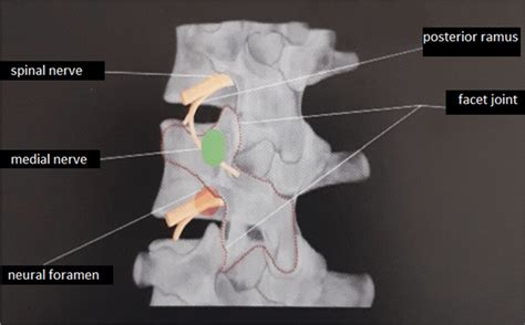 Complications Of Lumbar Facet And Medial Branch Blocks And Ablations Anesthesia Key