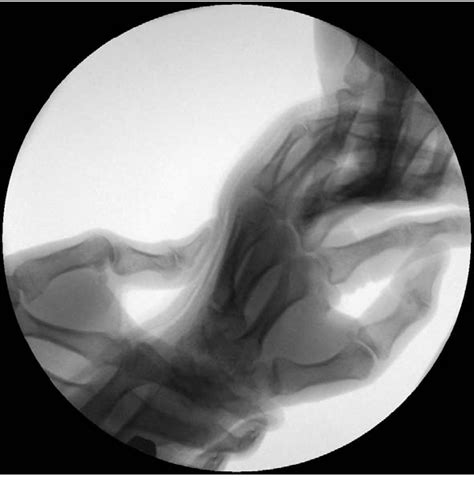 Figure 1 From Modified Split Ulnar Gutter Splint For Treatment Of Fifth