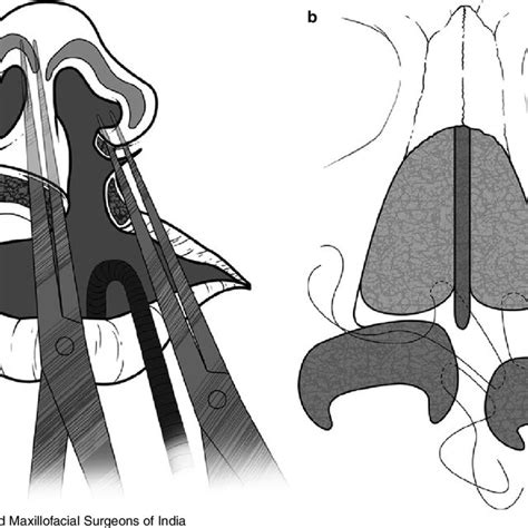 13 Alar Batten Grafting Demonstrated In A Case Of Unilateral Cleft Download Scientific Diagram