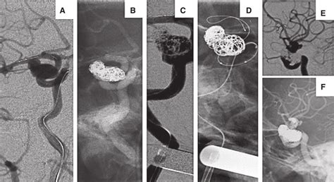 A Pre First Treatment B Post First Treatment Coil Embolization Download Scientific