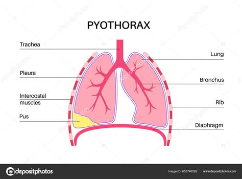 Pyothorax Empyème Pleural Maladie Inflammatoire Pulmonaire Infection Cavité Thoracique Région