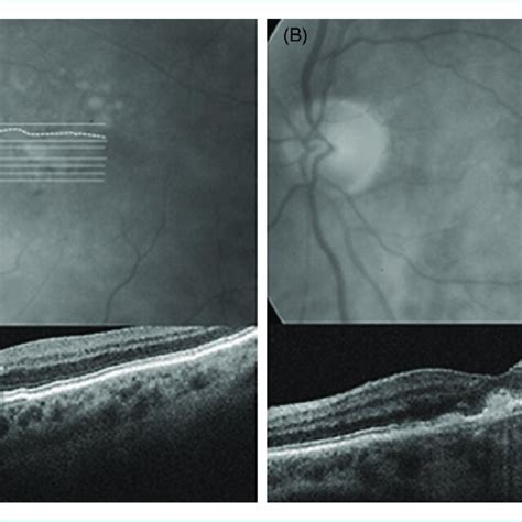 Macustat Hyperacuity Horizontal Scan A And Vertical Scan B With Download Scientific Diagram