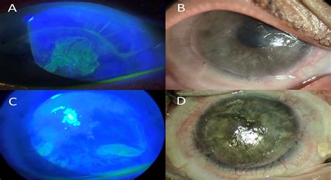 Decellularized Descemet Membrane Anterior Keratoplasty With Cornea