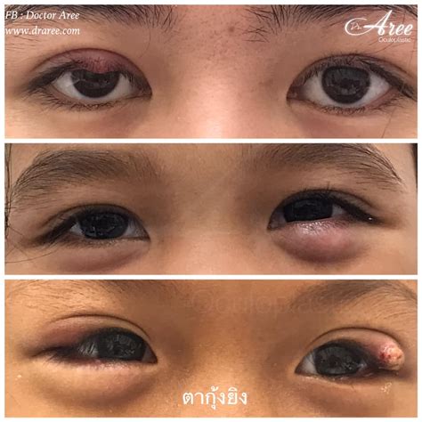 ยารักษาใจ 🧐 ตากุ้งยิง เกิดได้ยังไง