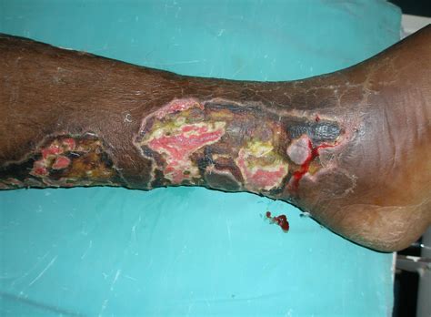 Pyoderma Gangrenosum Causes Symptoms Prognosis Treatment