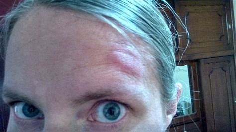 This And That From Here And There Bump On The Head