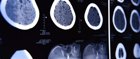 Artificial Intelligence For Dementia Diagnosis Genetic Analysis Speech Analysis And More