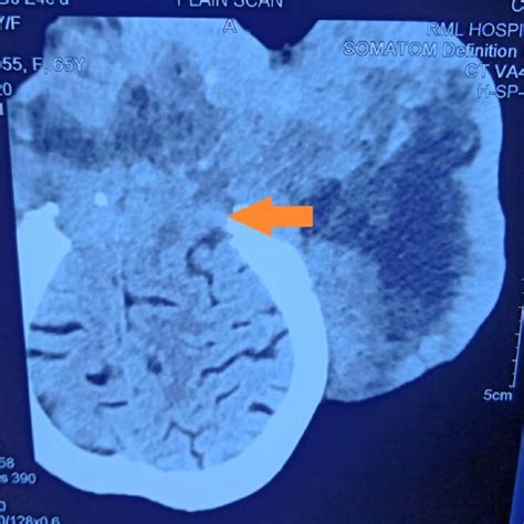 Computed Tomography Of The Head Showing Soft Tissue Mass Invading The Download Scientific