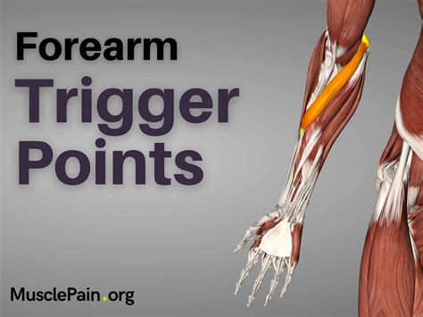 Forearm Trigger Points Muscle Pain