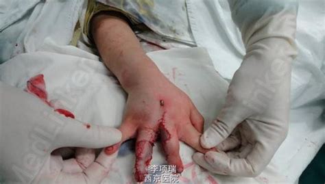 先天畸形另一例并指 医联