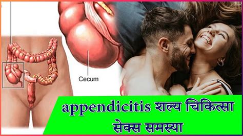 After Appendicitis Sex Lifein यौन शिक्षा Dr Samaram Sex Education