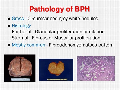 Ppt Benign Prostatic Hyperplasia Powerpoint Presentation Free Download Id 2768264