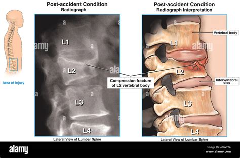 Compression Fracture Diagram