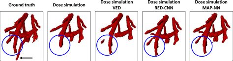Figure 6 From Impact Of Image Denoising Techniques On Cnn Based Liver Vessel Segmentation Using