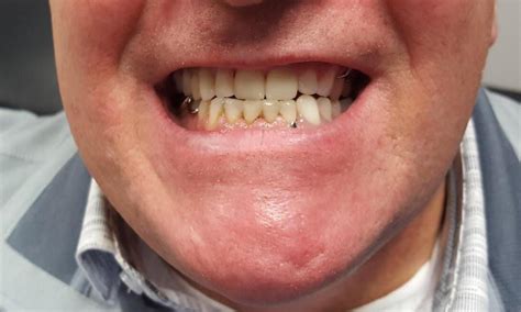 Southside Dental Centers Smile Gallery Upper And Lower Partial Dentures Crowns And Fillings