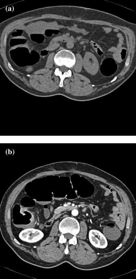 Ct Colonography In Cancer Detection Methods And Results Pmc