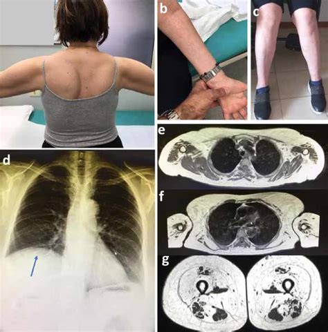 A Asymmetric Scapular Winging B Distal Arm Atrophy C Asymmetric