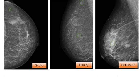 Figure 1 From Dual Fusion Mass Detector For Mammogram Mass Detection Semantic Scholar