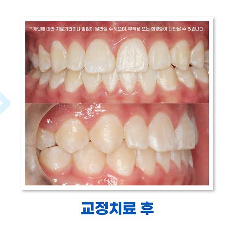 👉🏻성장기 아동 비발치 반대교합 교정 ⠀ 정상적인 노블치과교정과치과 소아교정청소년교정성인교정