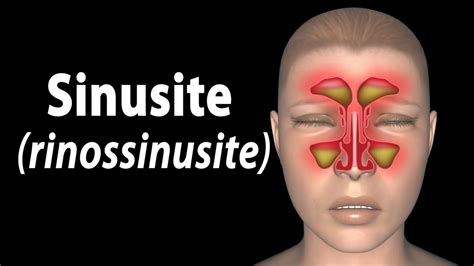 Sinusite Sintomas Tratamentos E Causas Saúde Blog Opas