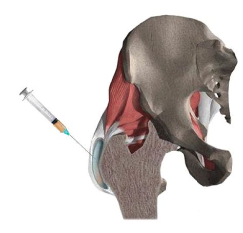 Tendinopatía Glútea Trocanteritis Synergia