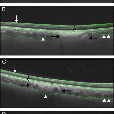Histogram Of The Horizontal Length Measurements Of Choroidal Nevi Download Scientific Diagram