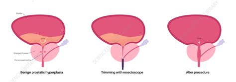 Transurethral Resection Of Prostate Conceptual Illustration Stock Image F0433421 Science